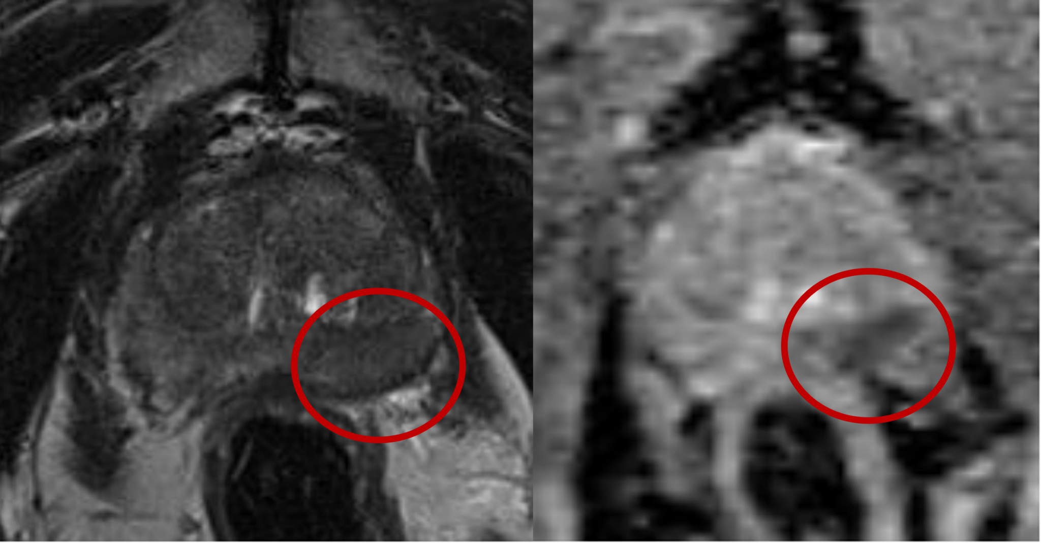 Multiparametrische MRT der Prostata – PDZB – Prostata Diagnostik ...